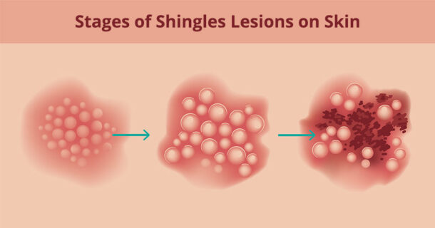 Shingles: Effective Management and Prevention