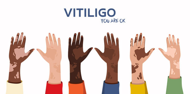 Vitiligo Signs You Should Not Ignore